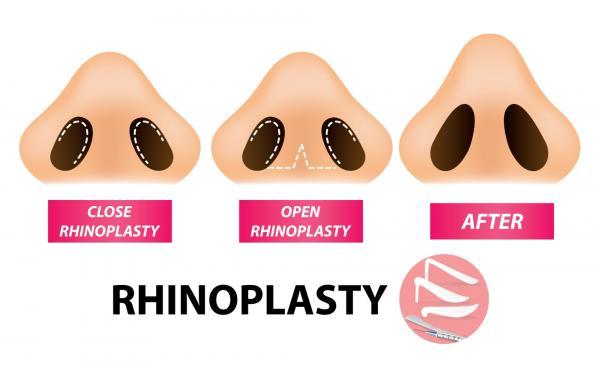Rhinoplasty in Turkey - Medical Center Turkey