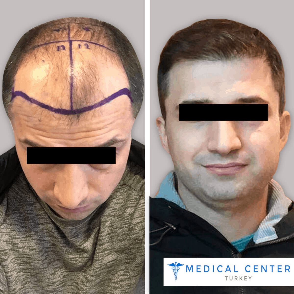 The Ultimate Hair Transplant Guide in Turkey