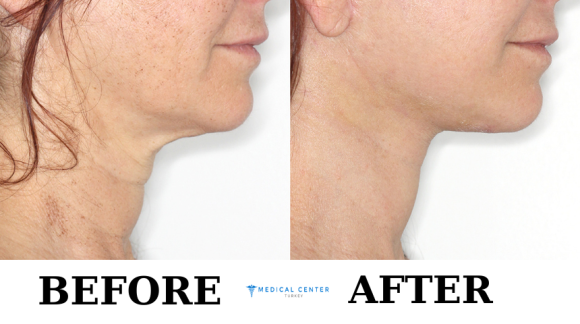 Neck Lift Cost in Turkey - Medical Center Turkey