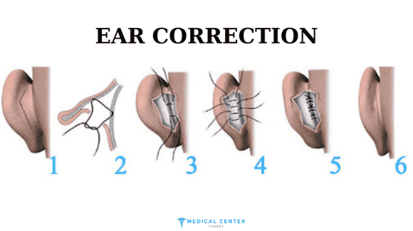 Ear Correction Surgery Cost in Turkey - MCT