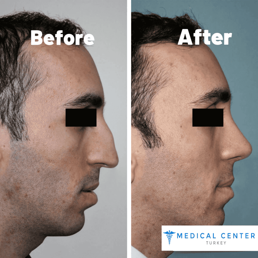 Male Rhinoplasty in Turkey - MCT