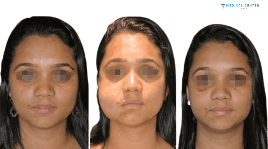 Bichectomy Surgery in Turkey - Medical Center Turkey