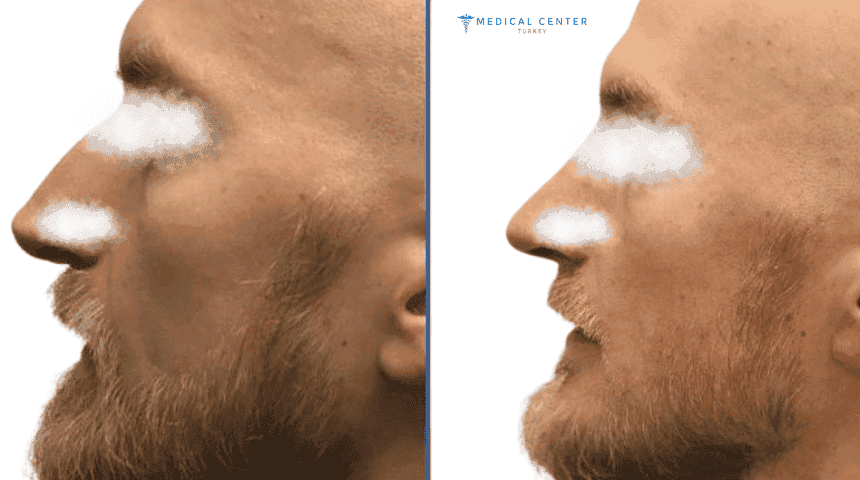 Male Rhinoplasty in Turkey - MCT