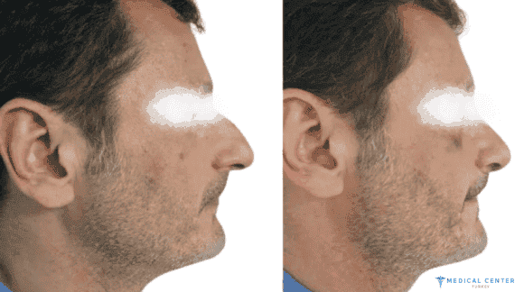 Male Rhinoplasty in Turkey - MCT
