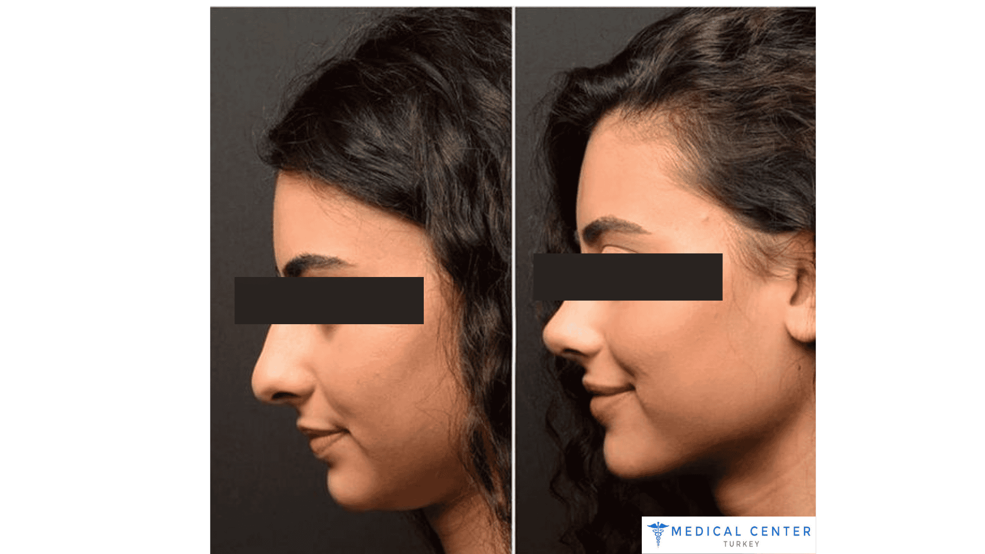 Female Rhinoplasty in Turkey- MCT