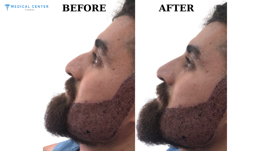 Beard Transplant Cost Turkey- MCT