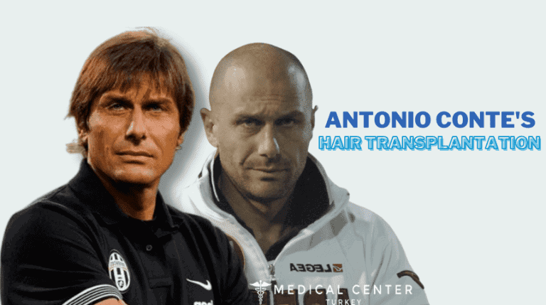 Antonio Conte's Hair Transplantation - MCT