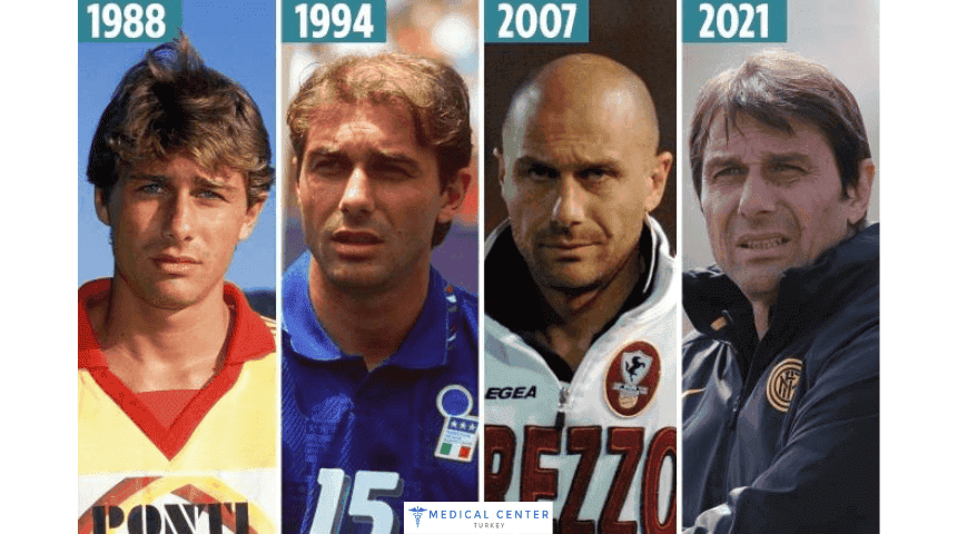 Antonio Conte's Hair Transplantation - MCT
