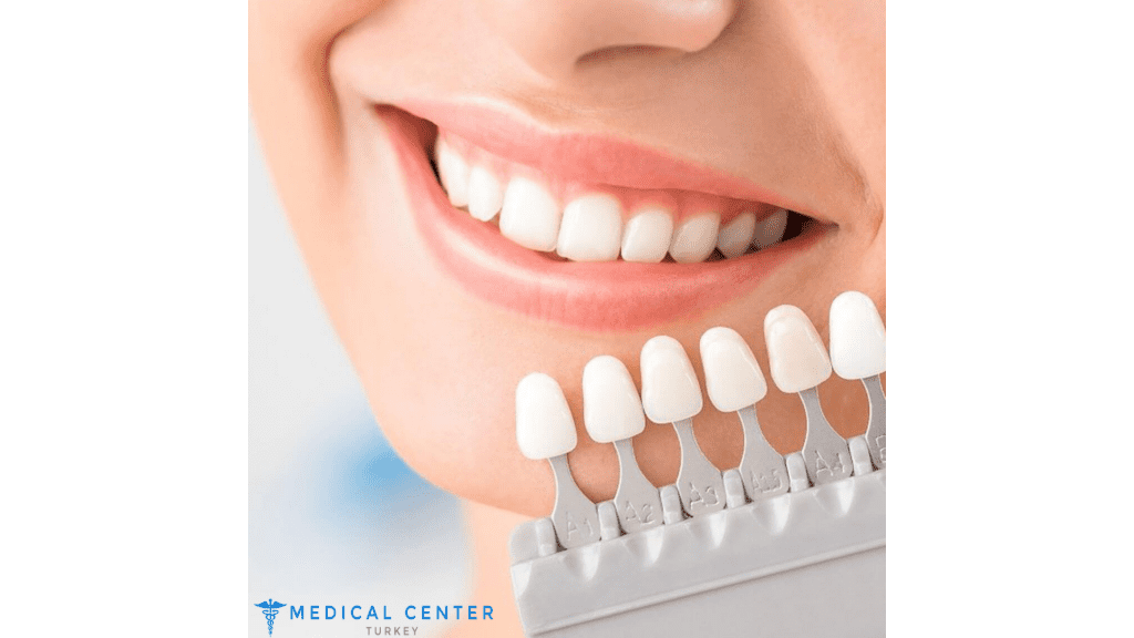 The Complete Guide to Veneers in Turkey - Medical Center Turkey