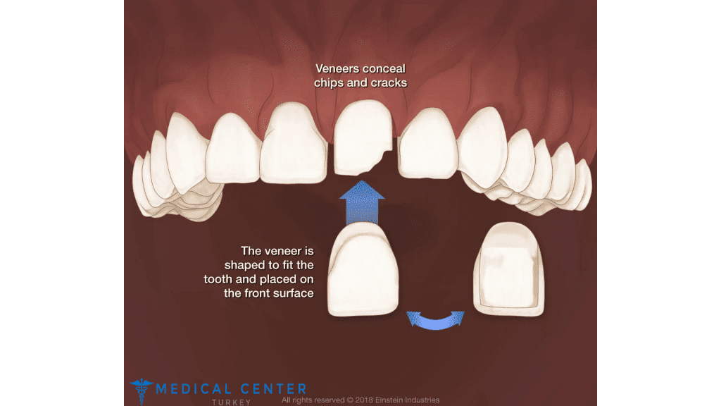 The Complete Guide to Veneers in Turkey - Medical Center Turkey