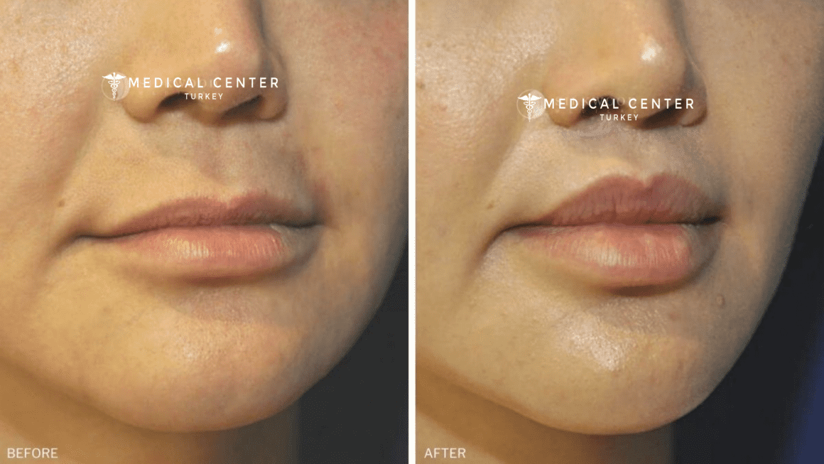 Lip Fillers vs Lip Lift - Medical Center Turkey