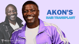 Akon's Hair Transplantation-MCT
