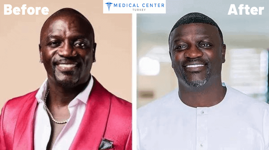 Akon's Hair Transplantation-MCT