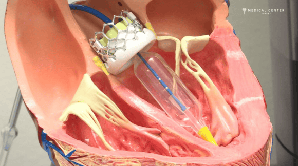 Trans Aortic Valve Replacement Surgery in Turkey - MCT