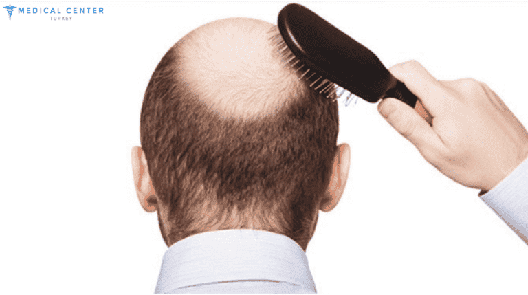 Shock Loss After Hair Transplant - MCT