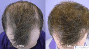How Minoxidil Works? - Medical Center Turkey
