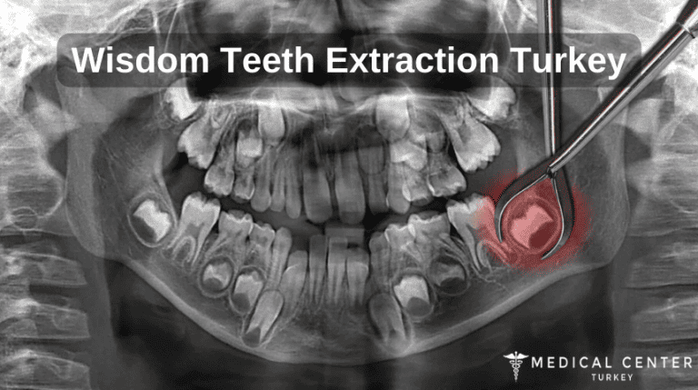 Wisdom Teeth Extraction Turkey - MCT
