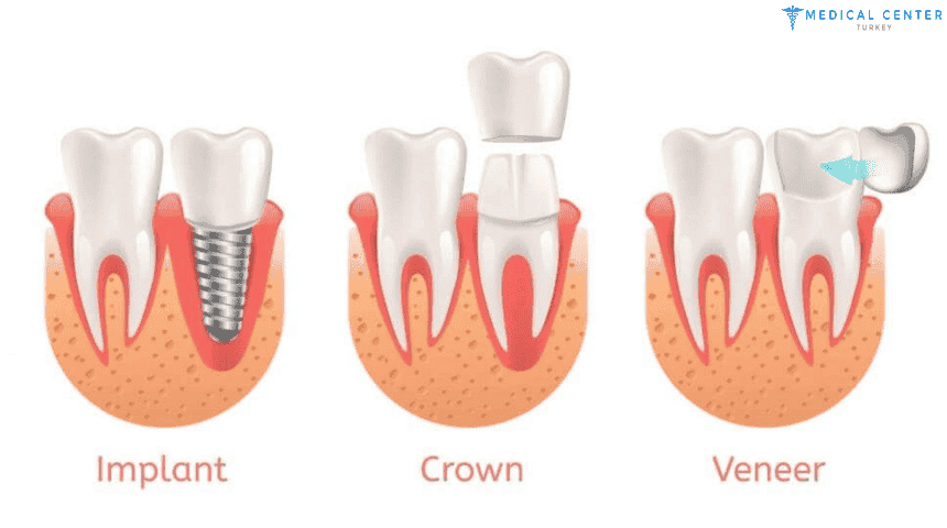 Are Veneers Bad For Your Teeth - MCT