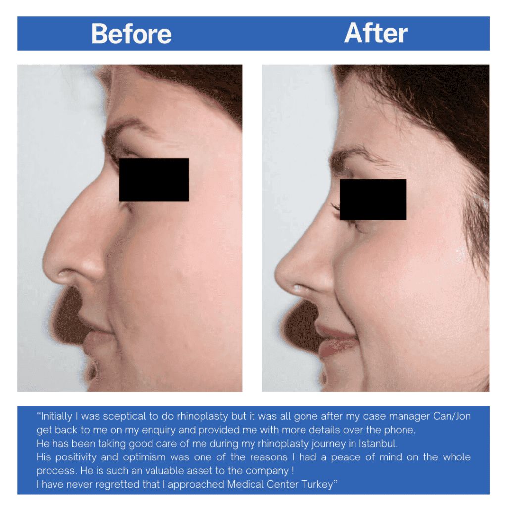 Rhinoplast (Nose Job) Before and After Turkey - MCT