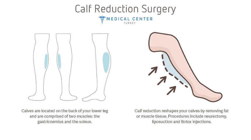 Calf Reduction: Pros and Cons of Selective Neurectomy - MCT