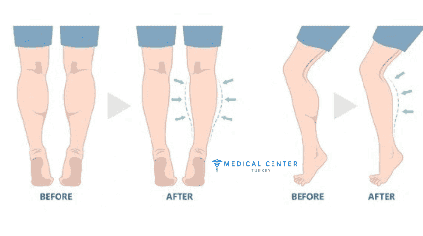 Calf Reduction: Pros and Cons of Selective Neurectomy - MCT