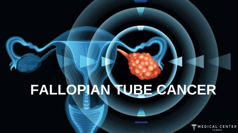 Fallopian Tube Cancer - MCT