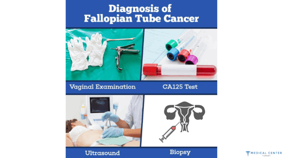 Fallopian Tube Cancer - MCT