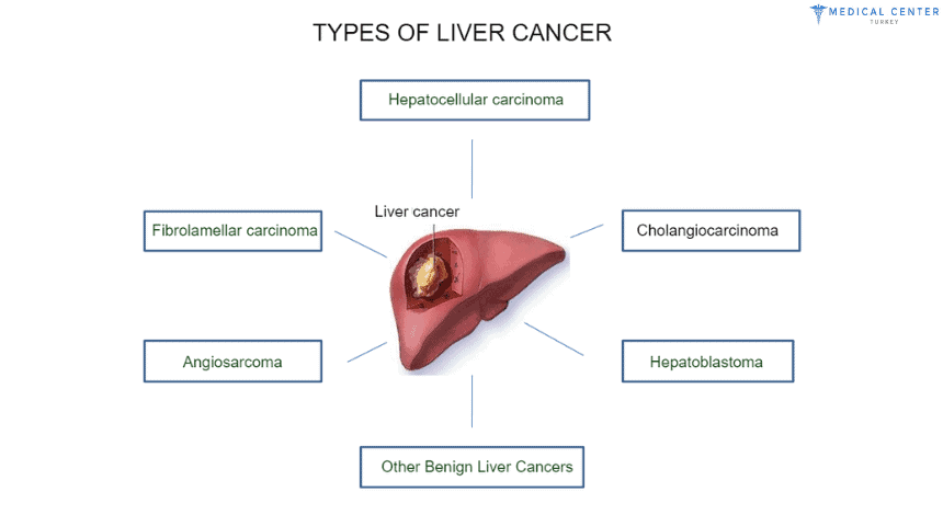 Liver Cancer in Turkey - MCT