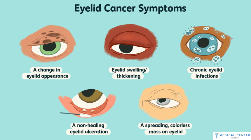 Eye Cancer - MCT