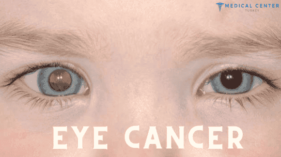Eye Cancer - MCT