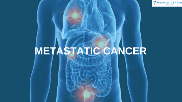 Metastatic Cancer - MCT