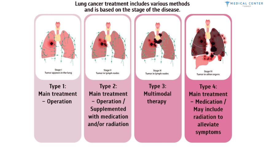 Lung Cancer Stage 4 in Turkey - MCT