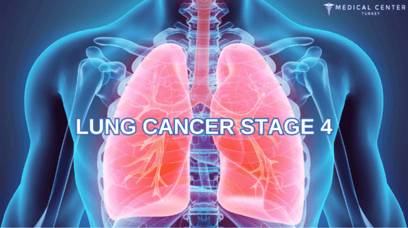 Lung Cancer Stage 4 - MCT