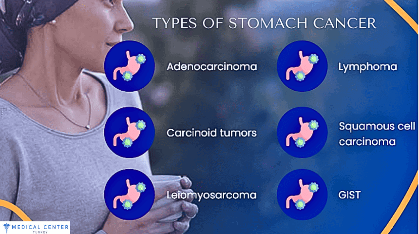 Stomach Cancer Stage 2 - MCT