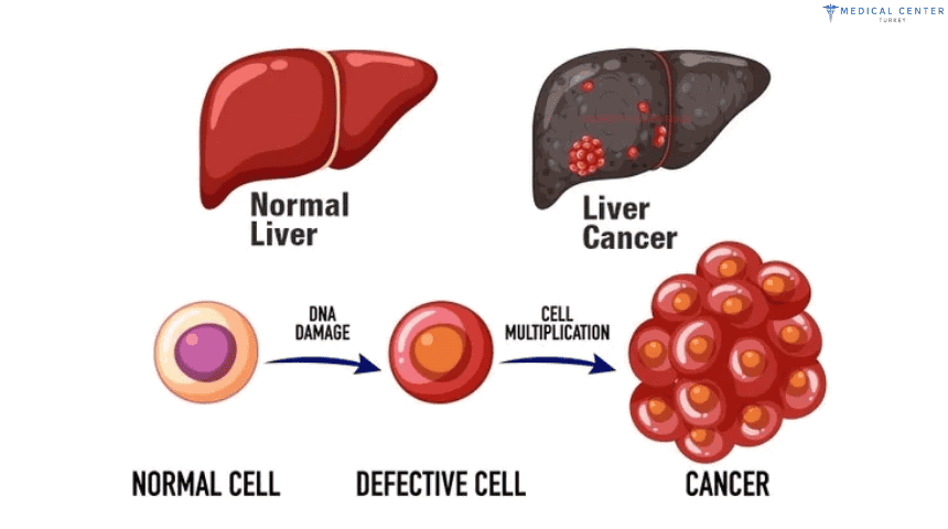 Liver Cancer Stage 3 - MCT