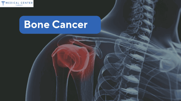 Bone Cancer - MCT