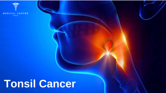 Tonsil Cancer - MCT