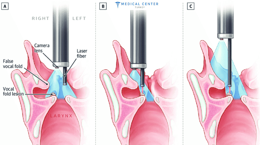 Laser Surgery for Laryngeal Cancer - MCT