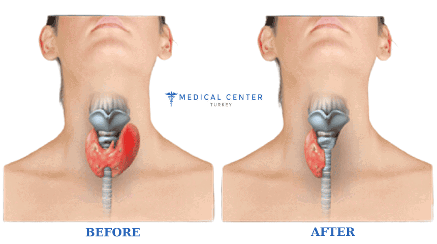Complex Treatment for Thyroid Cancer - MCT