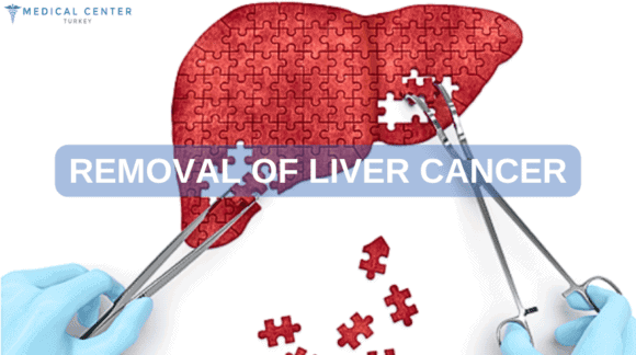Removal of Liver Cancer - MCT