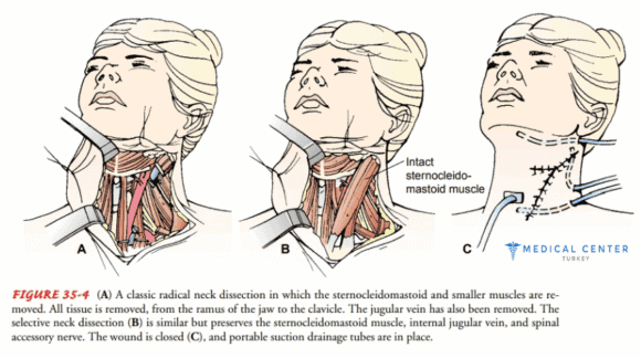 Throat Cancer Operation - MCT