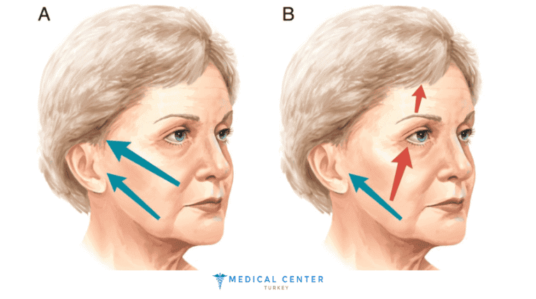 Facelift at Home: How to do Facelift without Surgery? - MCT