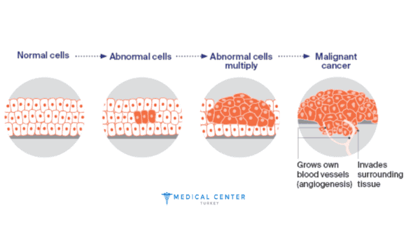 Which Cancer Types Are Deadly? - MCT