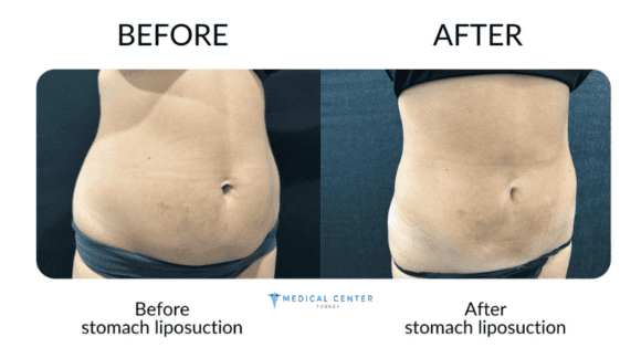 Liposuction Healing Time - MCT