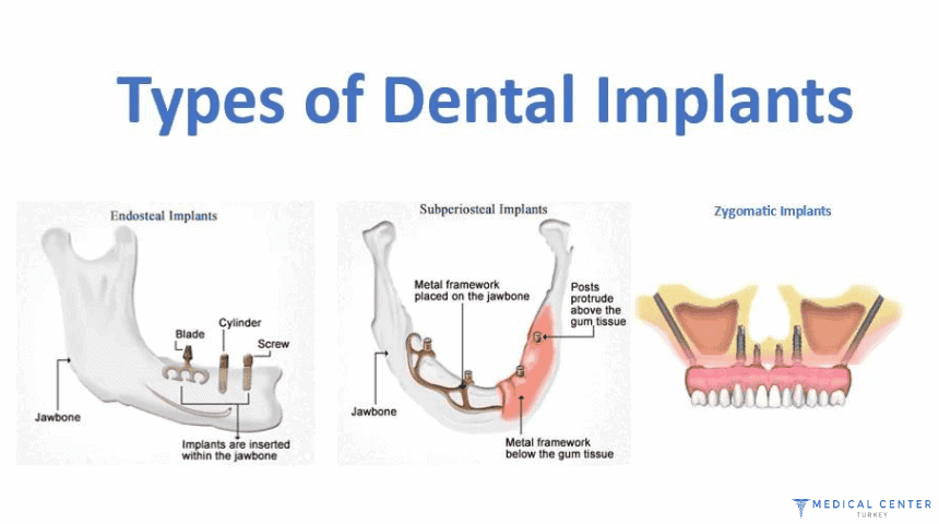 Dental Implants in Turkey: Types, Prices, Procedures - MCT