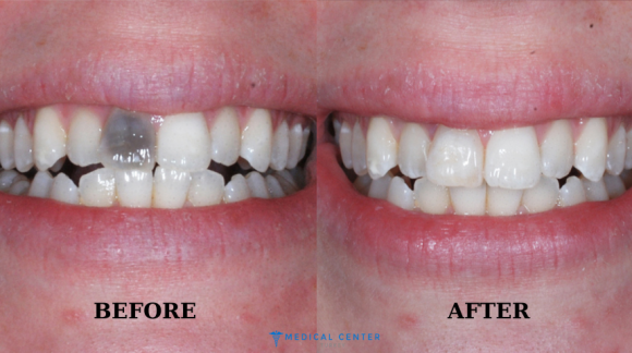 Black Teeth: Causes & Treatments in Turkey - Medical Center Turkey