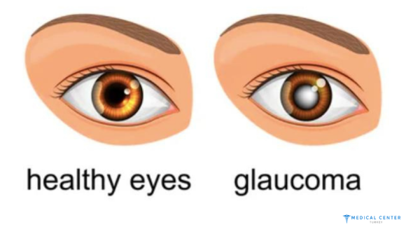 Types of Eye Operations in Turkey - Medical Center Turkey