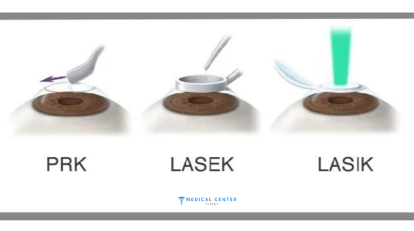 Types of Eye Operations in Turkey - Medical Center Turkey