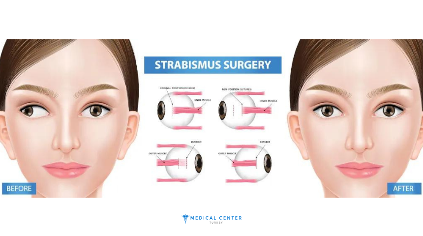 Types of Eye Operations in Turkey - Medical Center Turkey