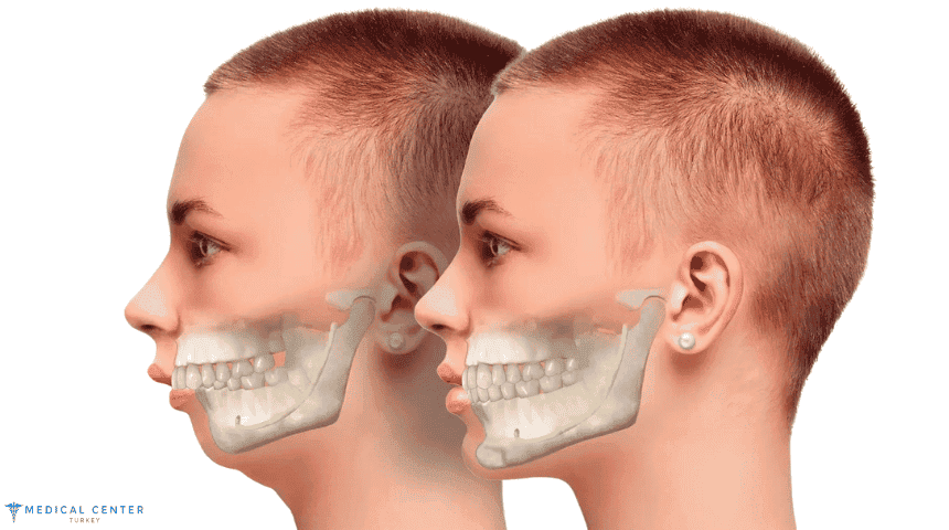 What Surgery is Best? 5 Types of Jaw Surgery in Turkey - Medical Center ...
